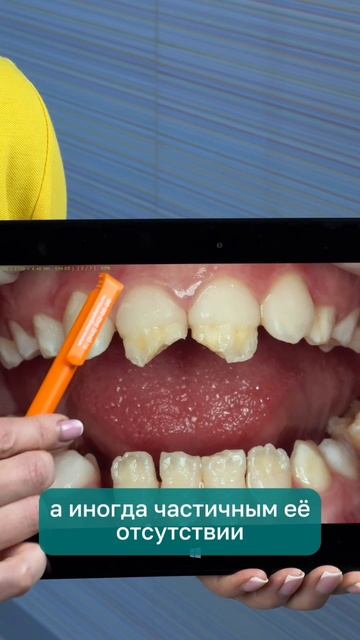 🦷 Гипоплазия эмали
