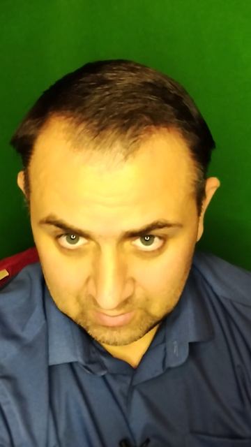 Мерфизмы в стоматологии 14.  Личный опыт. Удаления зубов с одной стороны.