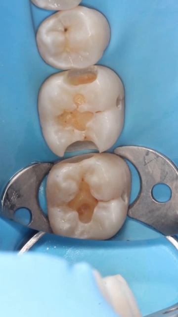 Пломба или реставрация? За что вы платите на самом деле 💰#реставрациязубов #качество #медицина