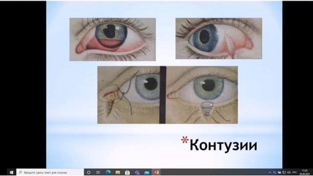 Лекция ТРАВМЫ ОРГАНА ЗРЕНИЯ 29_09_2021