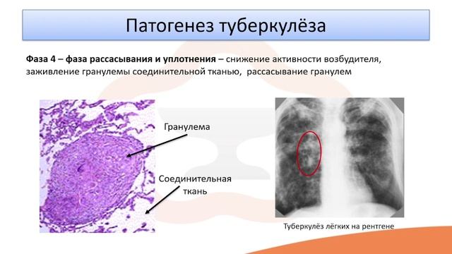 Лекция 4.7 Туберкулёз