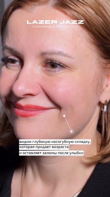 Результат до/после коррекции носогубных складок ❤️🔥