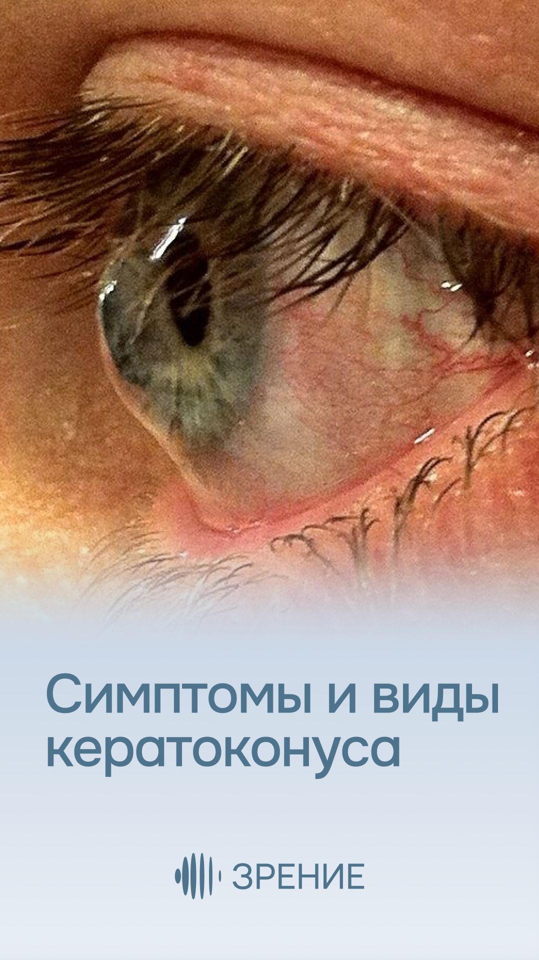 Кератоконус. Какой он бывает?
