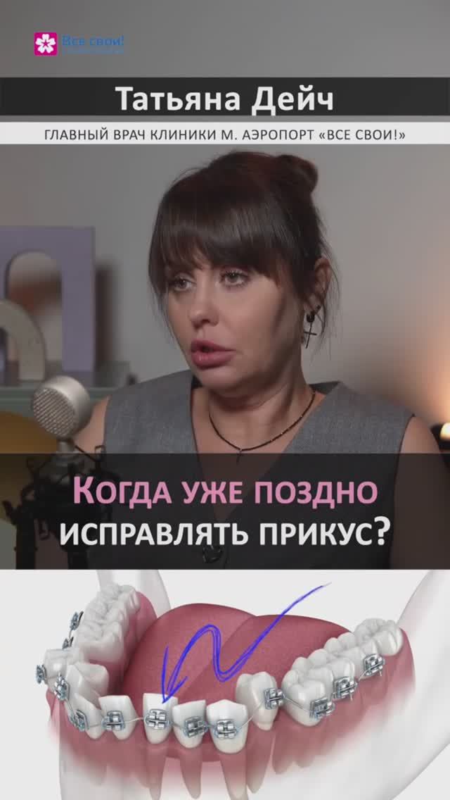 Когда поздно исправлять прикус. Ортодонтия при пародонтите: почему брекеты опасны при атрофии кости