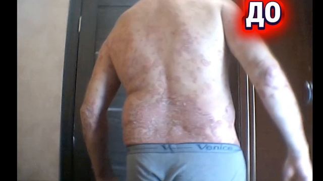 Псориаз ДО и ПОСЛЕ прослушивания программ МЭЦ