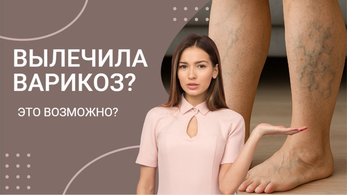 Вылечила варикоз без врачей - отзыв Рузанны о программах МЭЦ