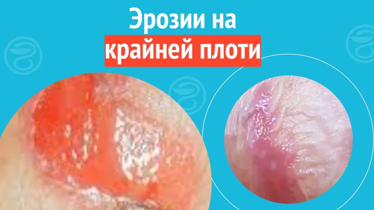 😟 Эрозии на крайней плоти. Клинический случай №1445