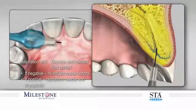 Нёбная анестезия с CompuDent STA