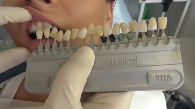 Подбор цвета зубов с помощью оригинальной шкалы VITA classical A1 - D4 Германия