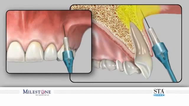 Инфильтрационная анестезия с CompuDent STA