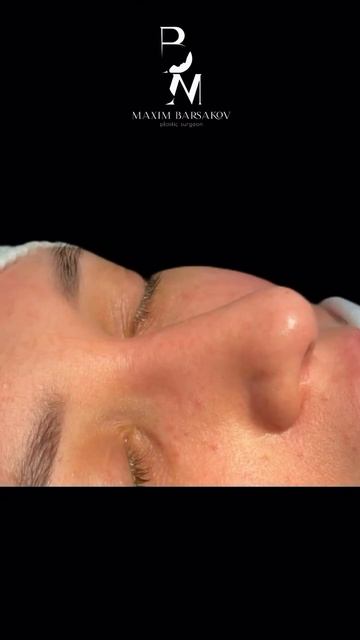 Ринопластика у Барсакова Максима Александровича: до/после