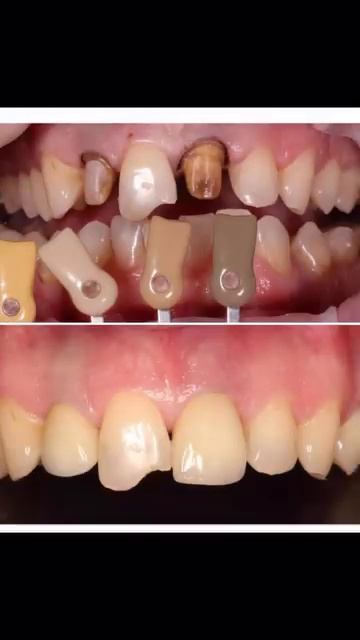 Керамика или композит? Идеальное сочетание! #стоматология #виниры #допосле #улыбка #shorts
