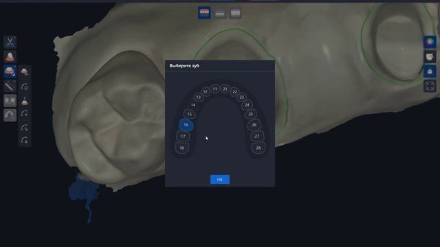 Как отметить границу препарирования в программе сканирования