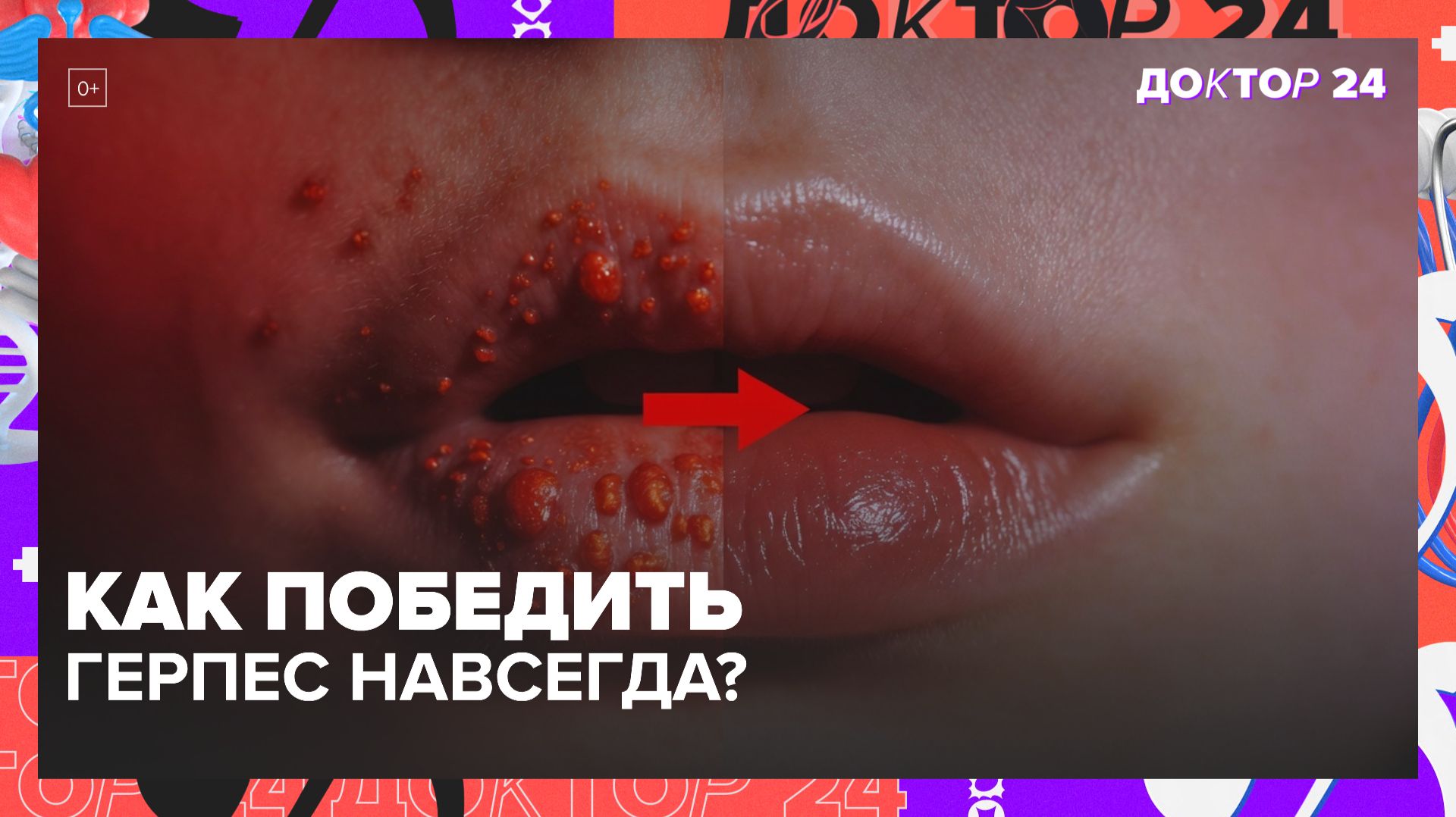 Простуда на губах: почему появляется снова и снова и как избавиться навсегда? | Доктор 24