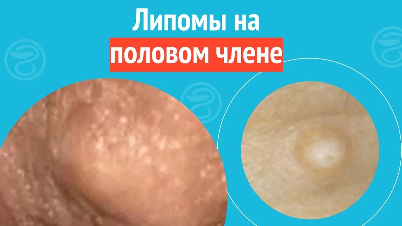 👉 Липомы на половом члене. Клинический случай № 1716