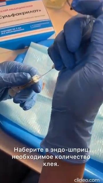 Применение клея Сульфакрилат