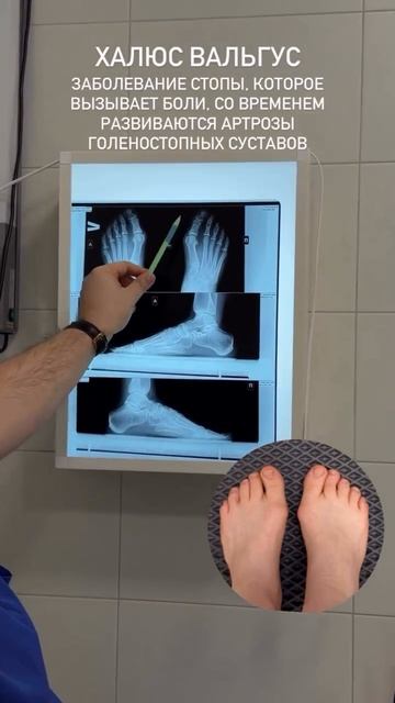 Халюс вальгус. Лечение. ЛД Медицина