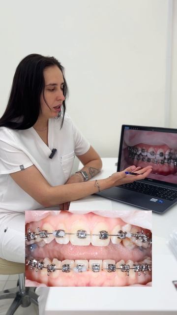 Разбор нового кейса от врача-стоматолога-ортодонта, Сафиулиной Анастасии Михайловны.