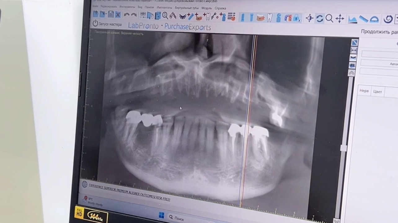 Кейс от стоматолога-хирурга, имплантолога