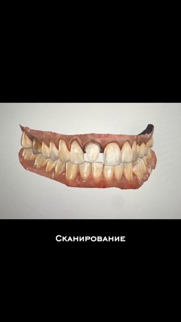 Реставрация и протезирование: что изменилось в улыбке #улыбка #протезирование #зубы #shorts