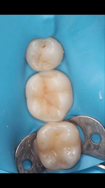 Когда пломба становится зубом #шортс #reels #shortsvideo #стоматолог #реставрациязубов #