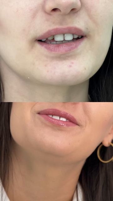 Улыбка до/после