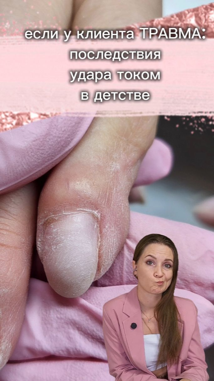 Как сделать маникюр и укрепление на травмированном пальце? Hohtar