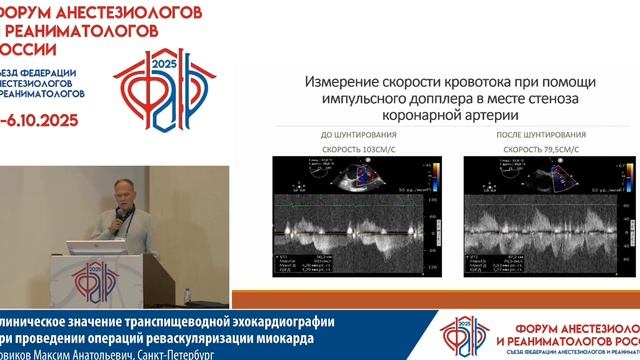 Транспищеводная эхоКГ при операц реваскуляриз миокарда Новиков М.А. . 2025