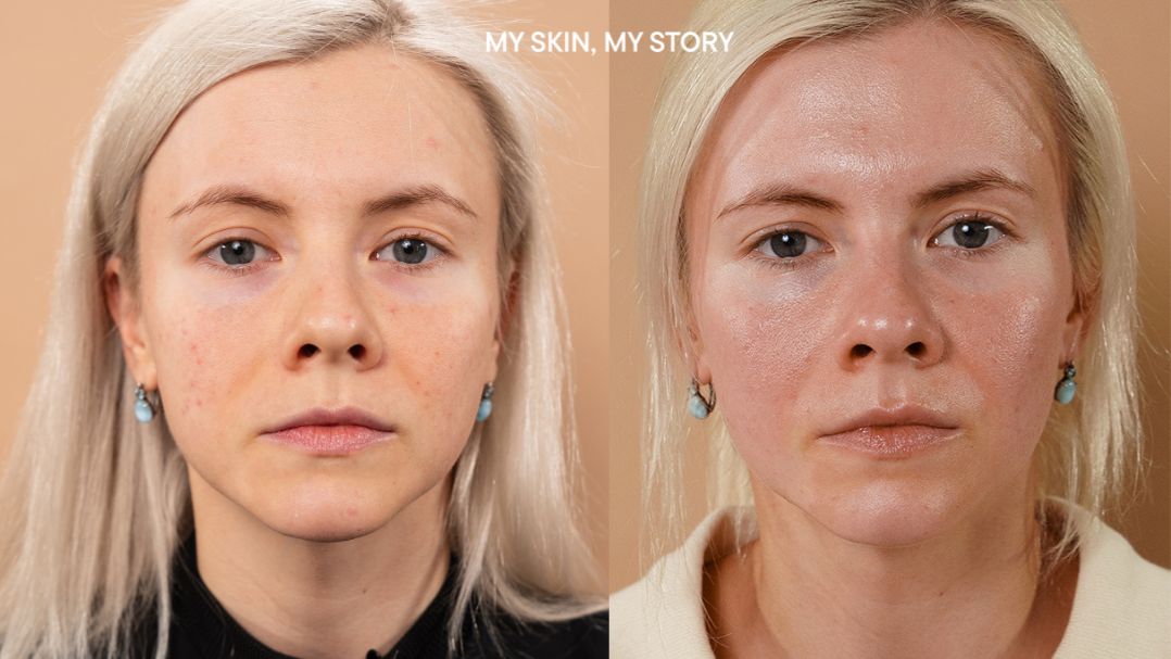 BABOR_MY SKIN, MY STORY: Как восстановить кожу при розацеа и сухости