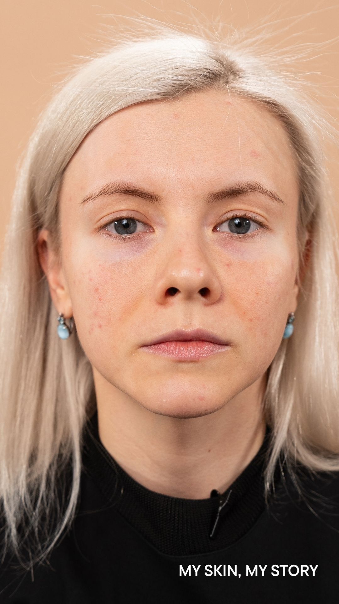 BABOR_MY SKIN, MY STORY: сухость, покраснения и высыпания при активном образе жизни