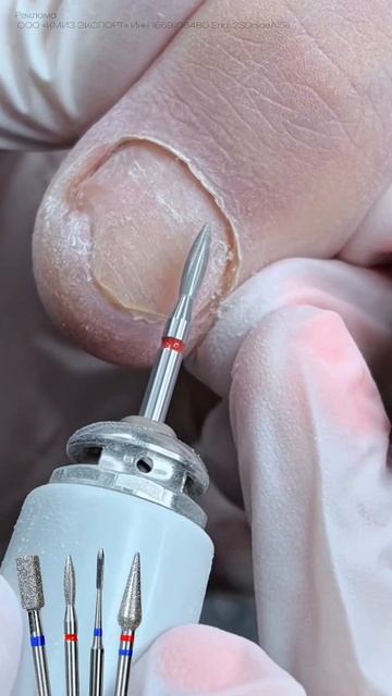 В чем важный факт зачистки онихолизиса рассказываю в видео 🤫 финальная часть в ленте