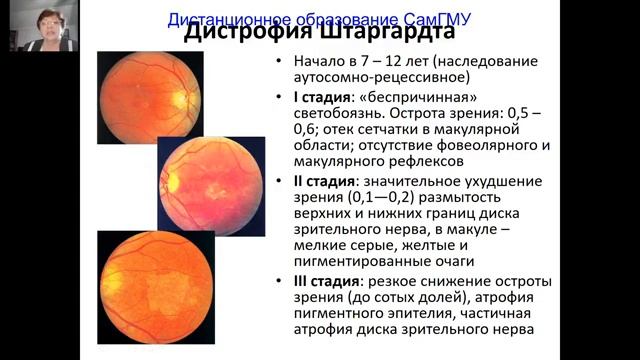 Патология глазного дна часть 2