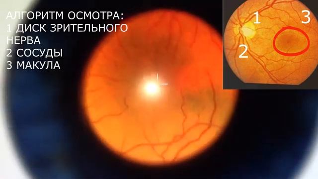 ОФТАЛЬМОСКОПИЯ ПАТОЛОГИЯ7