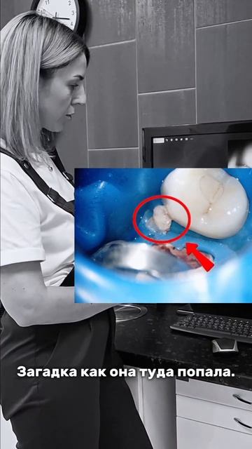 Сложный клинический случай из практики #эндодонтия #лечениеканалов #стоматология #shorts