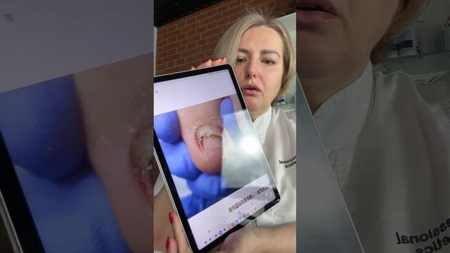 ПОДНОГТЕВОЙ ГИПЕРКЕРАТОЗ, что это и как с ним работать?