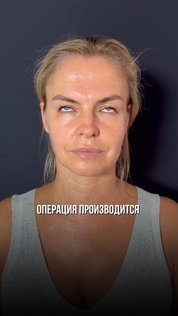 Лобно-височный лифтинг