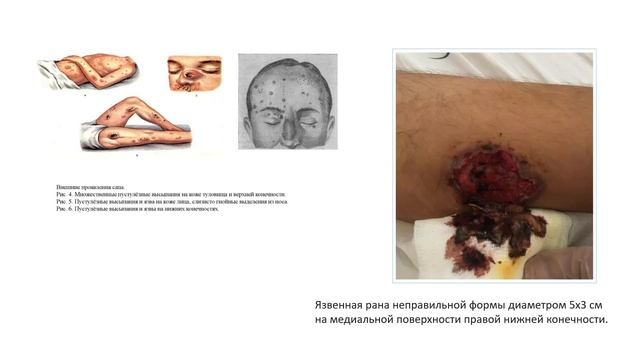 Лечение, диагностика и профилактика сапа