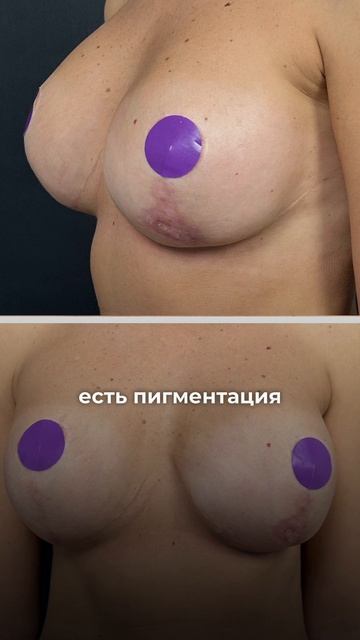 Исправление работы другого хирурга при осложнениях