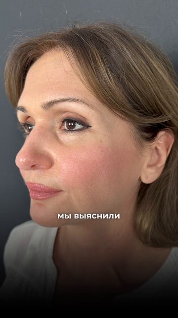 Классическая блефаропластика