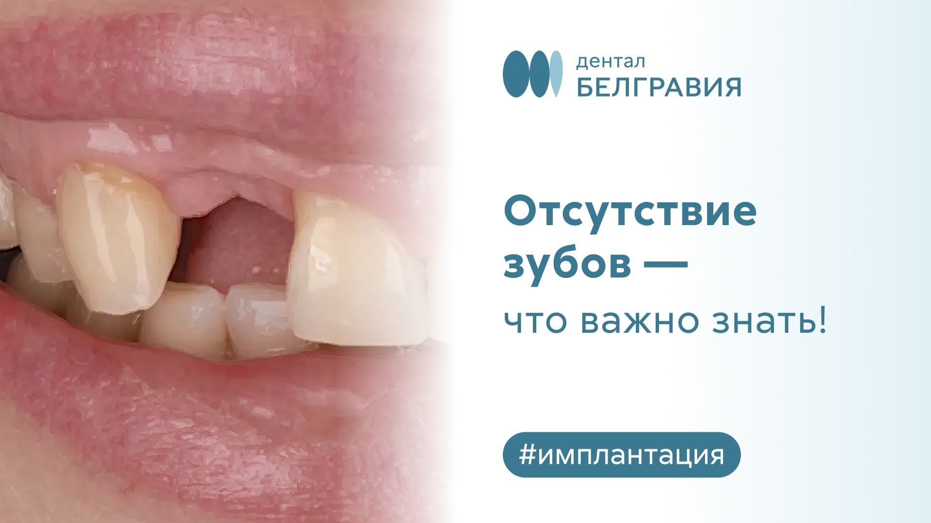 👉 Отсутствие зубов — что важно знать!