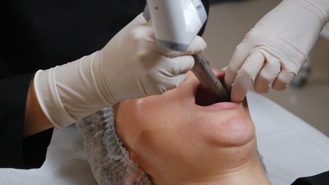 Интраоральный лифтинг