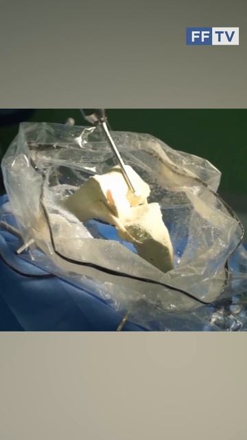 КОГДА ПРИМЕНЯЕТСЯ РОБОТ CUVIS #здоровье #медицина #роботы #хирургия #shorts