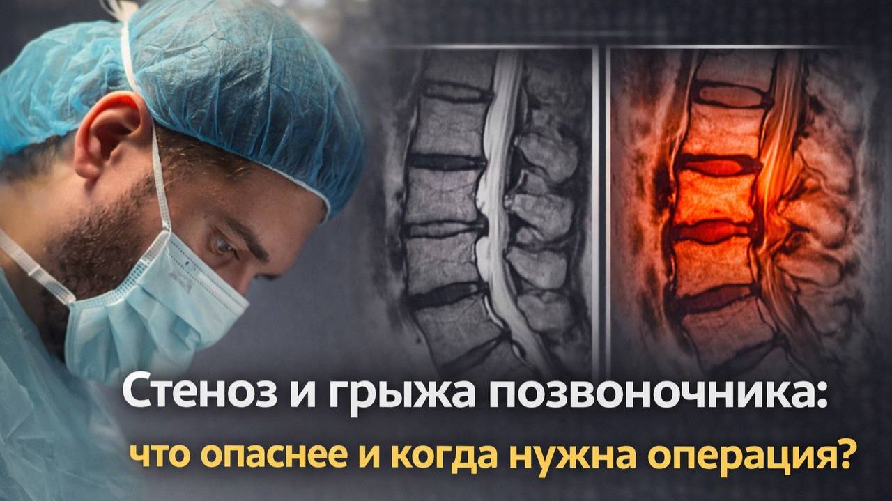 Грыжа или стеноз? Разные ли это диагнозы. Отличие в лечении и восстановлении