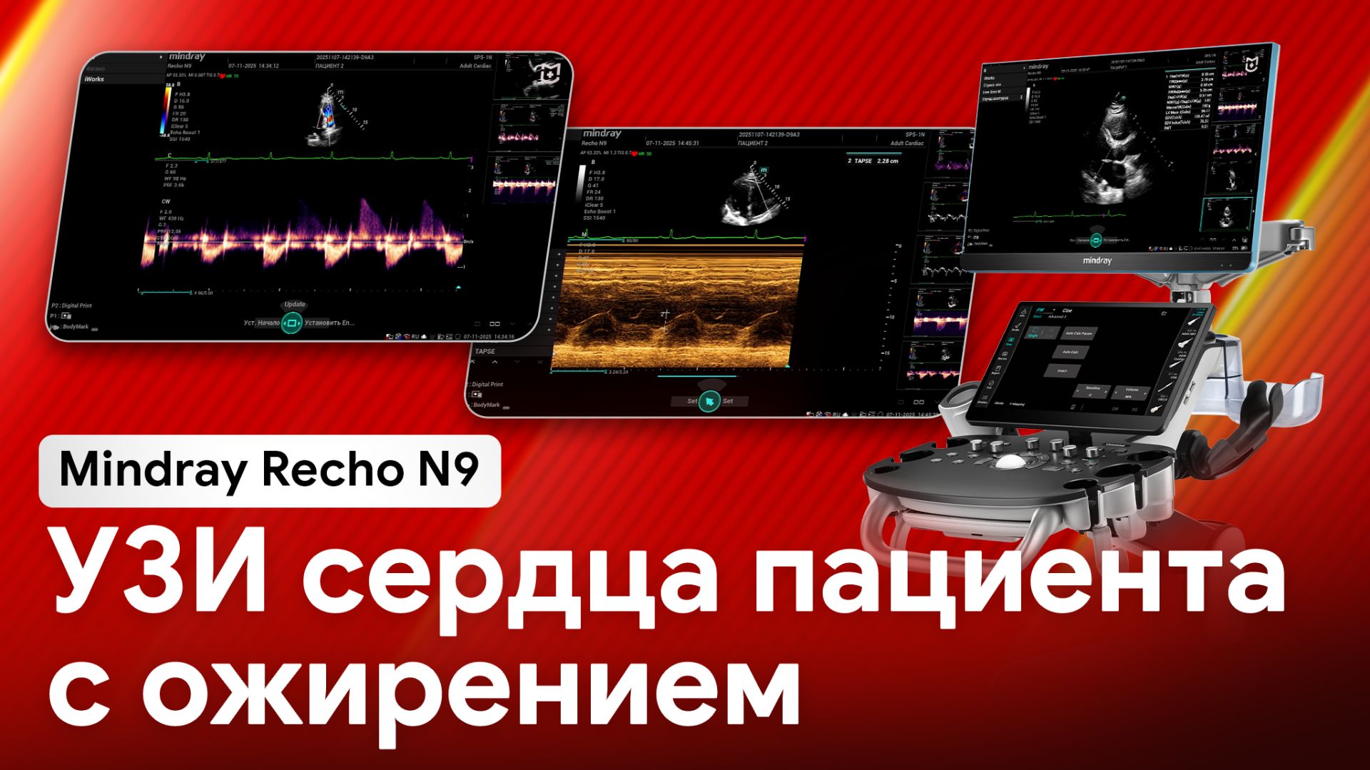 На что способен Mindray Recho N9? Визуализация сердца пациента с ожирением