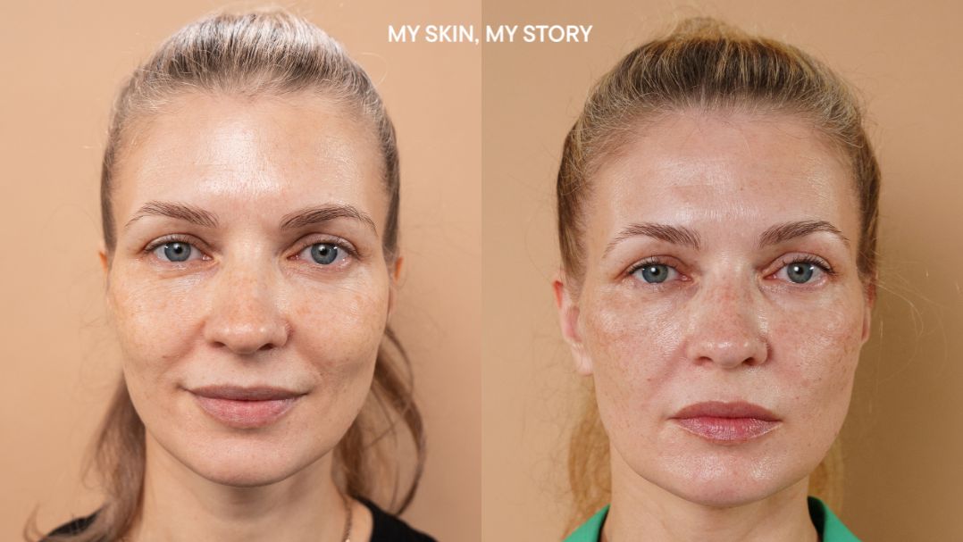 BABOR_MY SKIN, MY STORY: Возрастная сухость кожи и пигментация — реальный кейс ухода