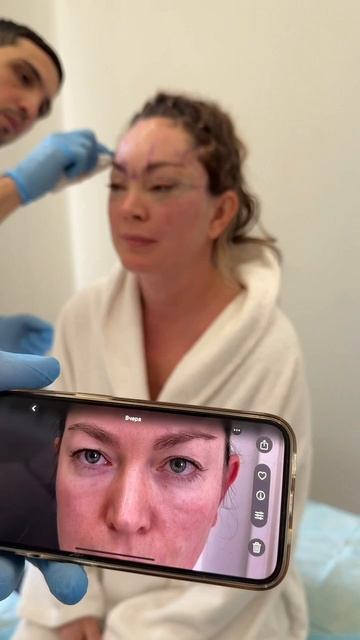 #омоложение_лица: на следующий день после операции