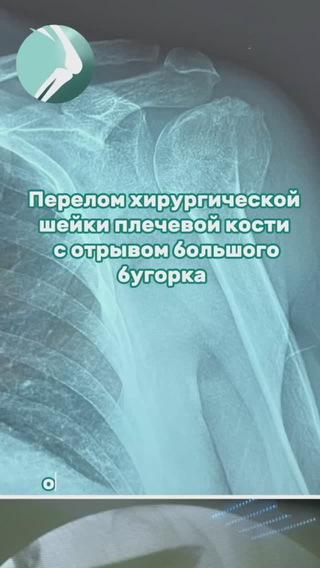 Остеосинтез титановой пластиной шейки плечевой кости. ЛД Медицина.