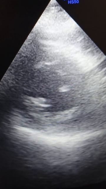 Эхокг с тяжелым аортальным стенозом.