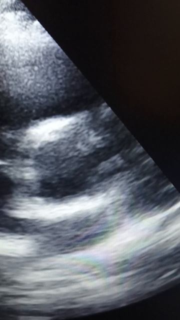 двустворчатый аортальный клапан.