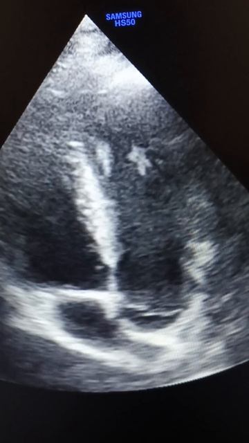 двустворчатый аортальный клапан продолжение.